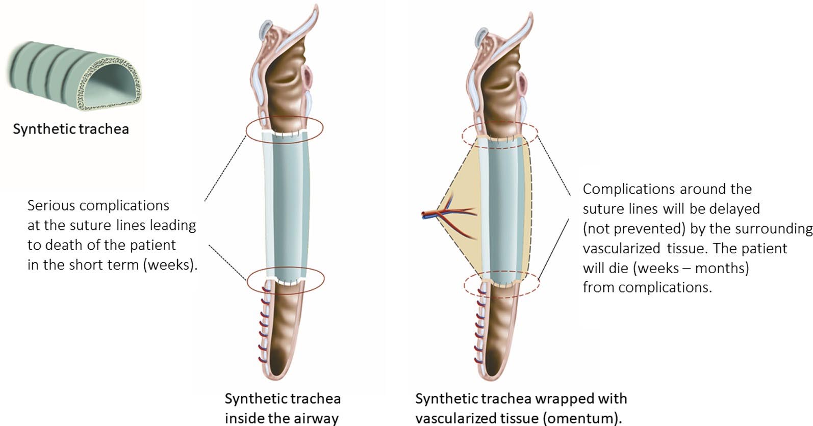 Commentary: The sobering truth about tracheal regeneration - World Stem ...